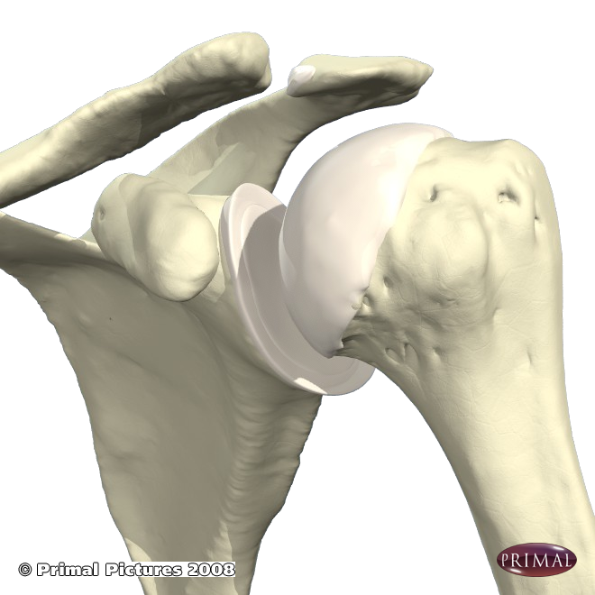 Acromioclavicular Joint Sprain/ Separation | Lakeland Chiropractic